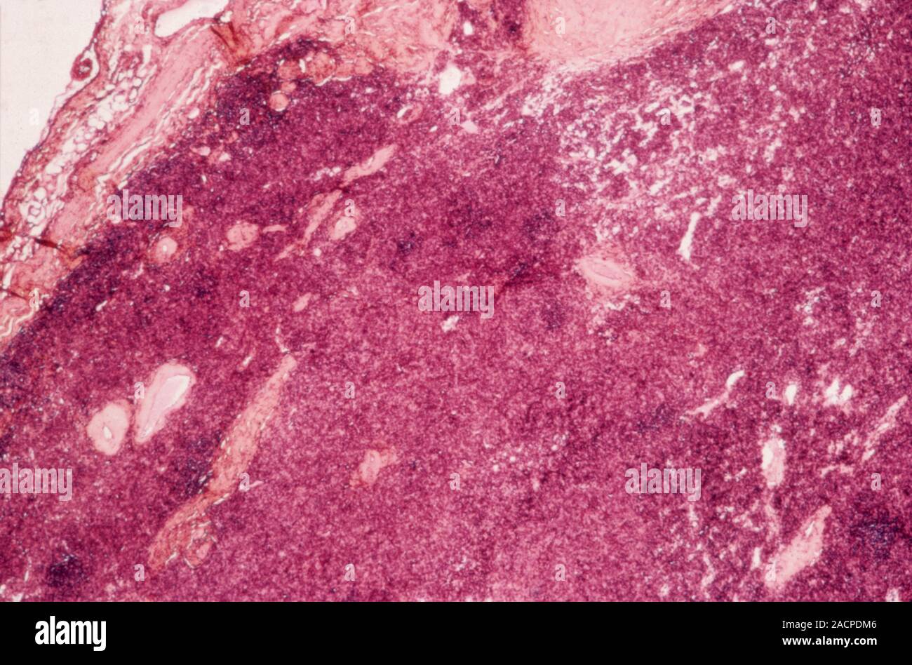 Thymus cancer. Light micrograph of a section through a thymus gland ...
