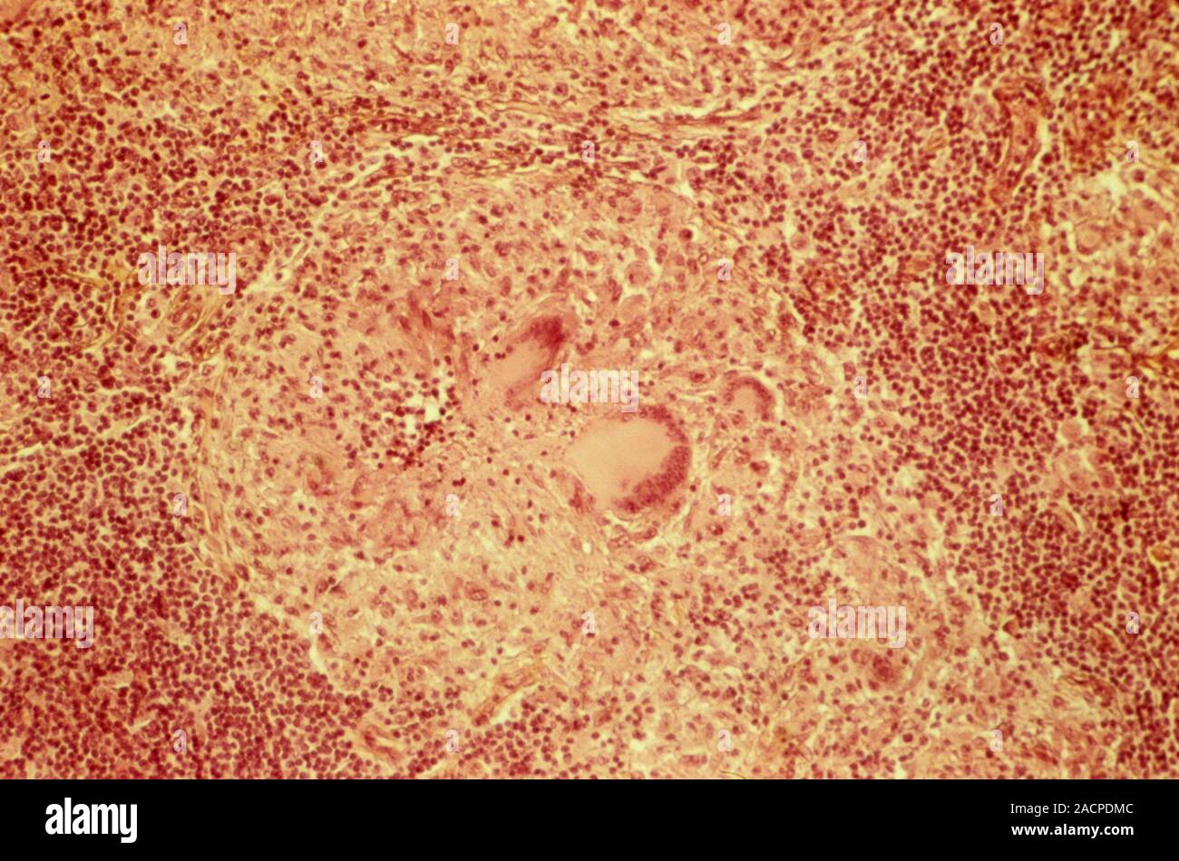 Tuberculosis. Light micrograph of a section through a lymph node in ...