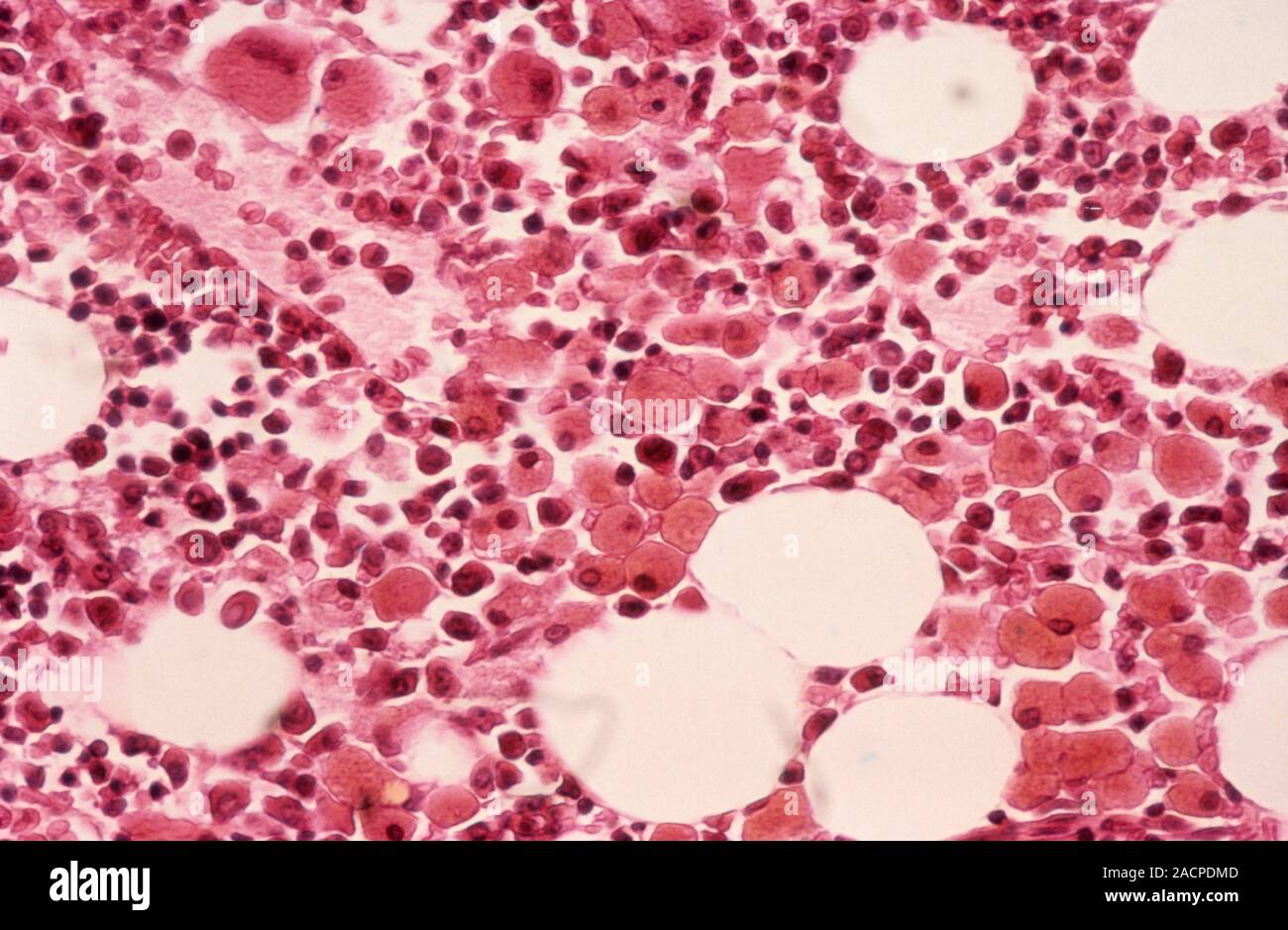 Niemann-Pick disease. Light micrograph of a section through bone marrow ...