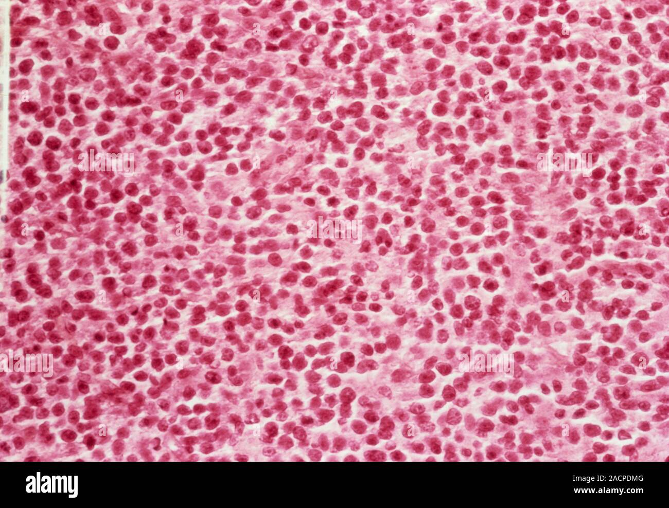 Reticulosarcoma. Light micrograph of reticulocyte blood cells (red, one ...