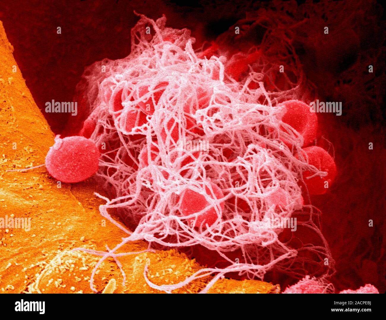 Blood clot. Coloured scanning electron micrograph (SEM) of a blood clot ...