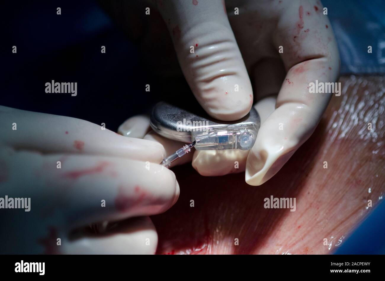 Heart pacemaker surgery. Surgeon performing surgery to fit a pacemaker ...