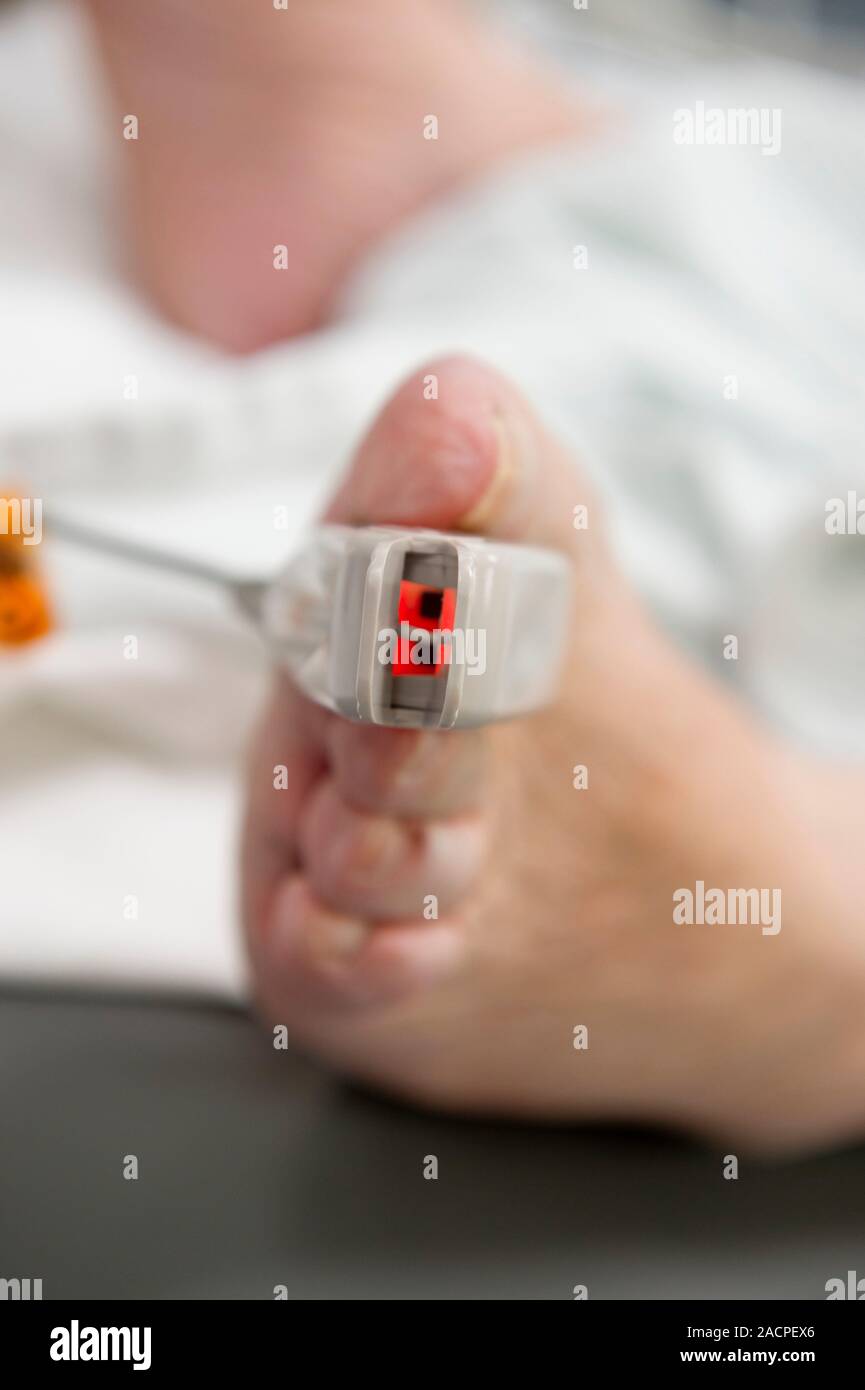 Blood oxygen monitor on the toe of a patient during surgery. This ...