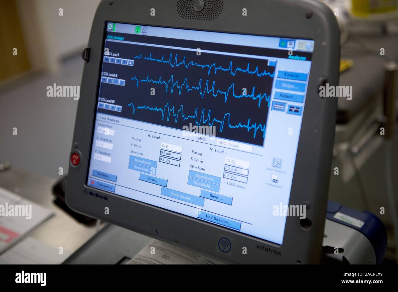 Heart pacemaker surgery. Screen showing the heart rate of a patient ...