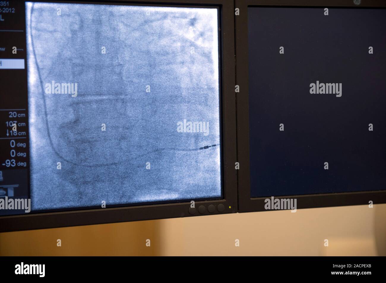Heart pacemaker surgery. Angiography being used during surgery to fit a ...
