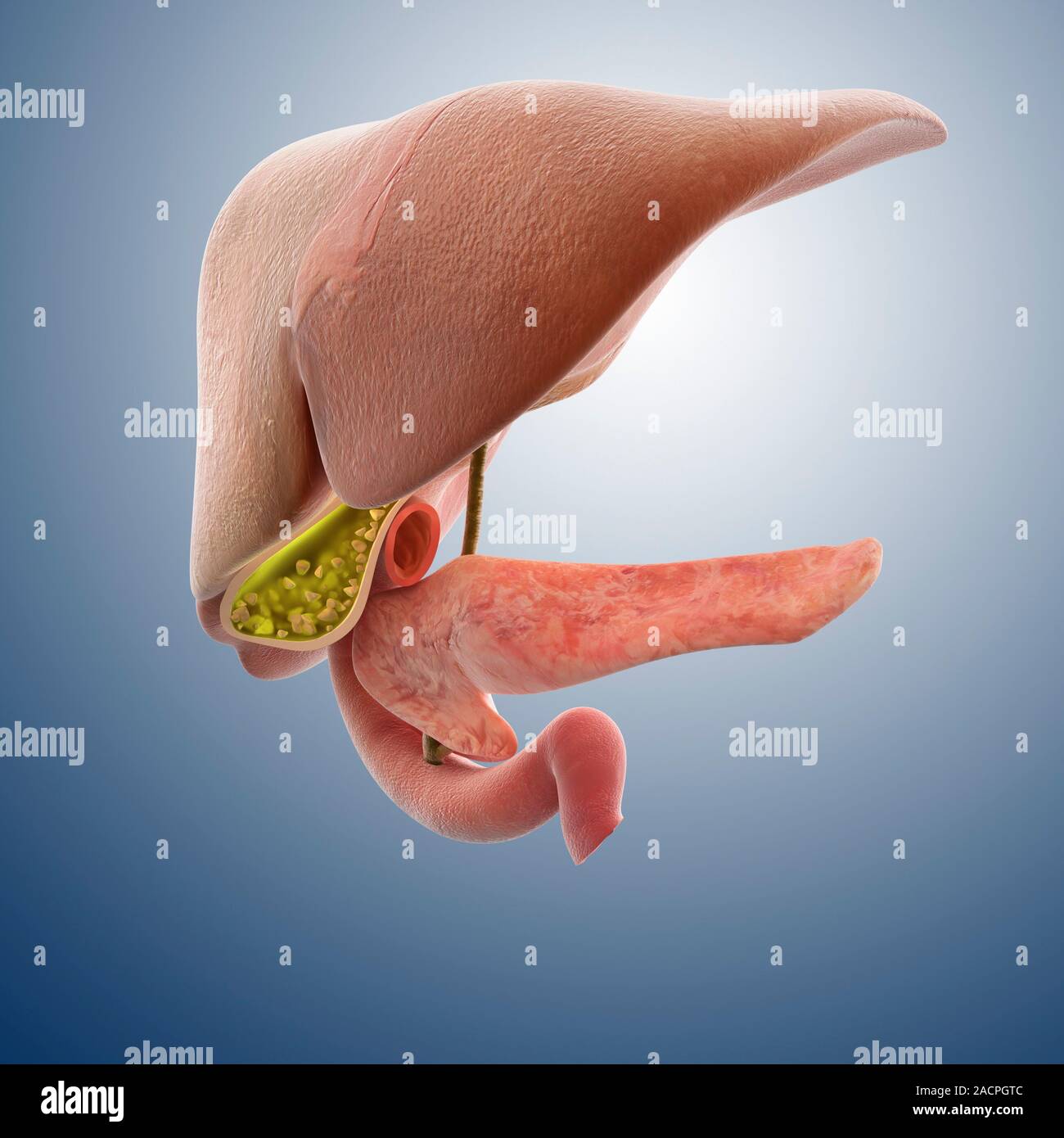 Gallstones. Artwork of the gallbladder (yellow), ducts, and surrounding ...