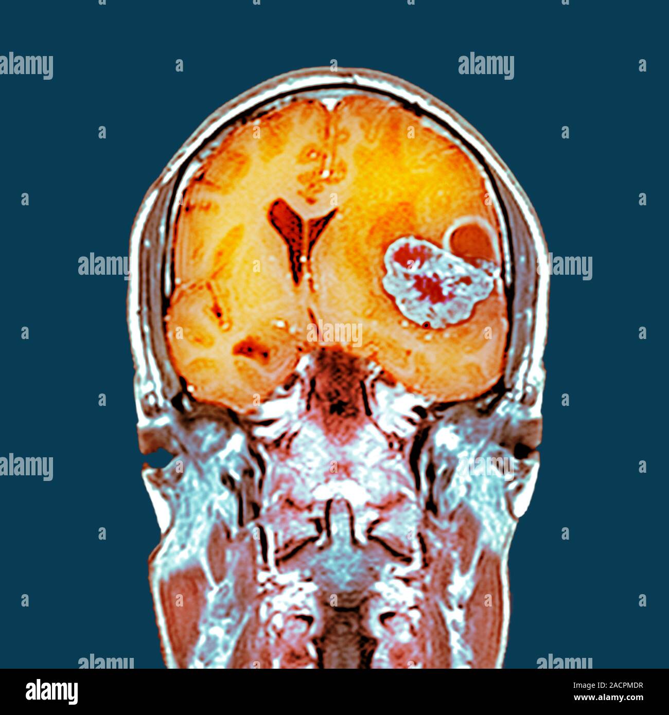 Brain cancer. Coloured coronal magnetic resonance imaging (MRI) scan through the head of a 48 ...