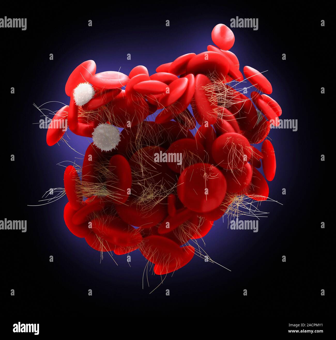 Blood clot, computer artwork. Red blood cells (erythrocytes) are ...
