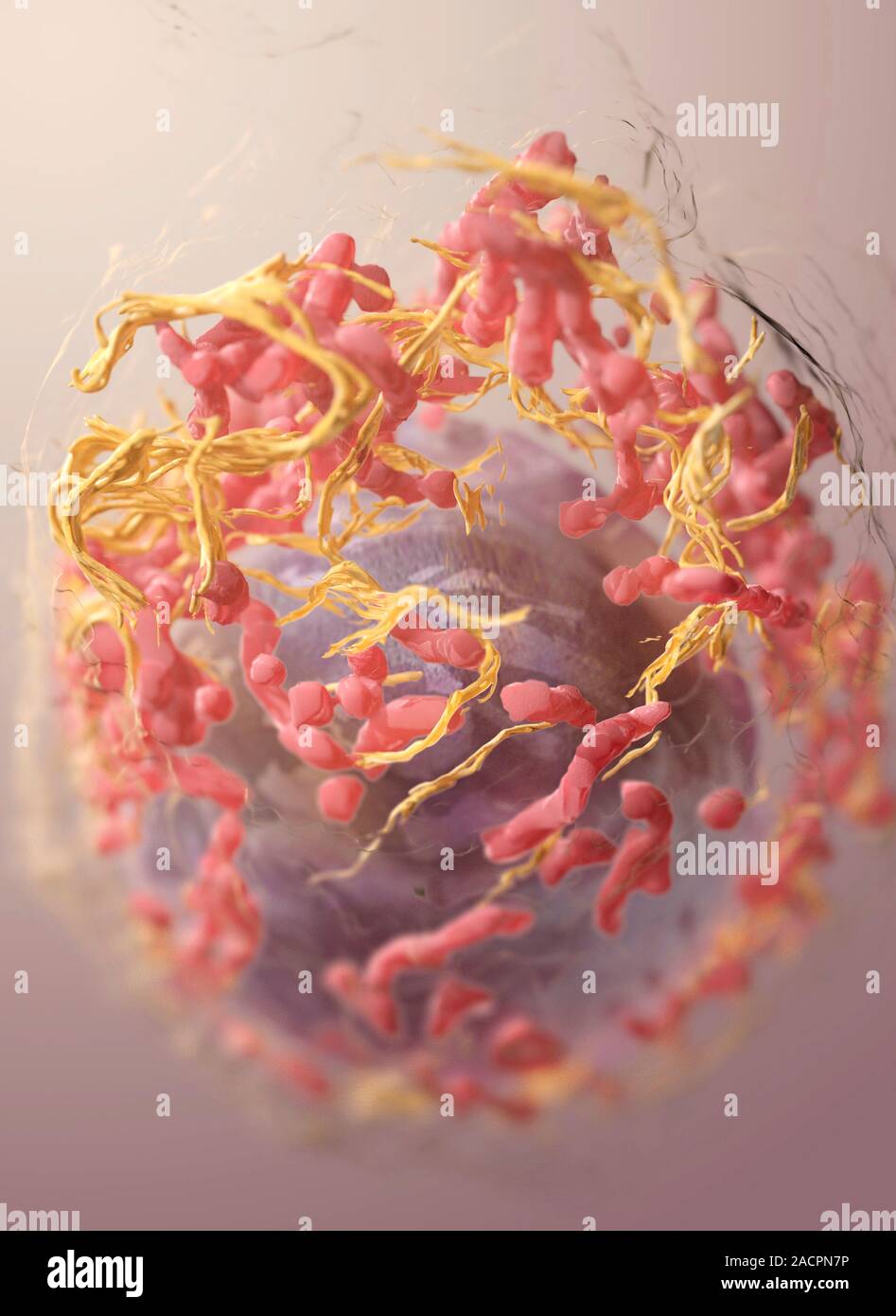 Skin cancer cell. Coloured ion-abrasion scanning electron micrograph ...