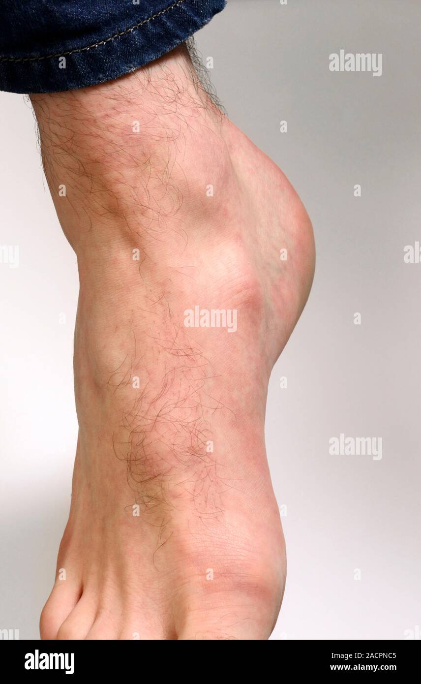 Not for use in Television Not for use in Television Accessory navicular ...