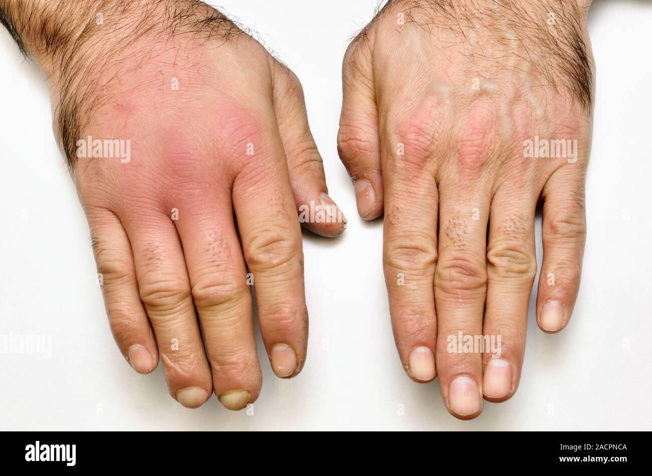 Not for use in Television Not for use in Television Cellulitis of the ...