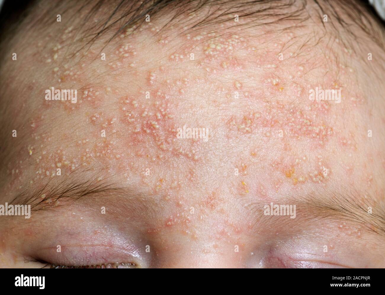 Not for use in Television Not for use in Television Milia on a baby's ...