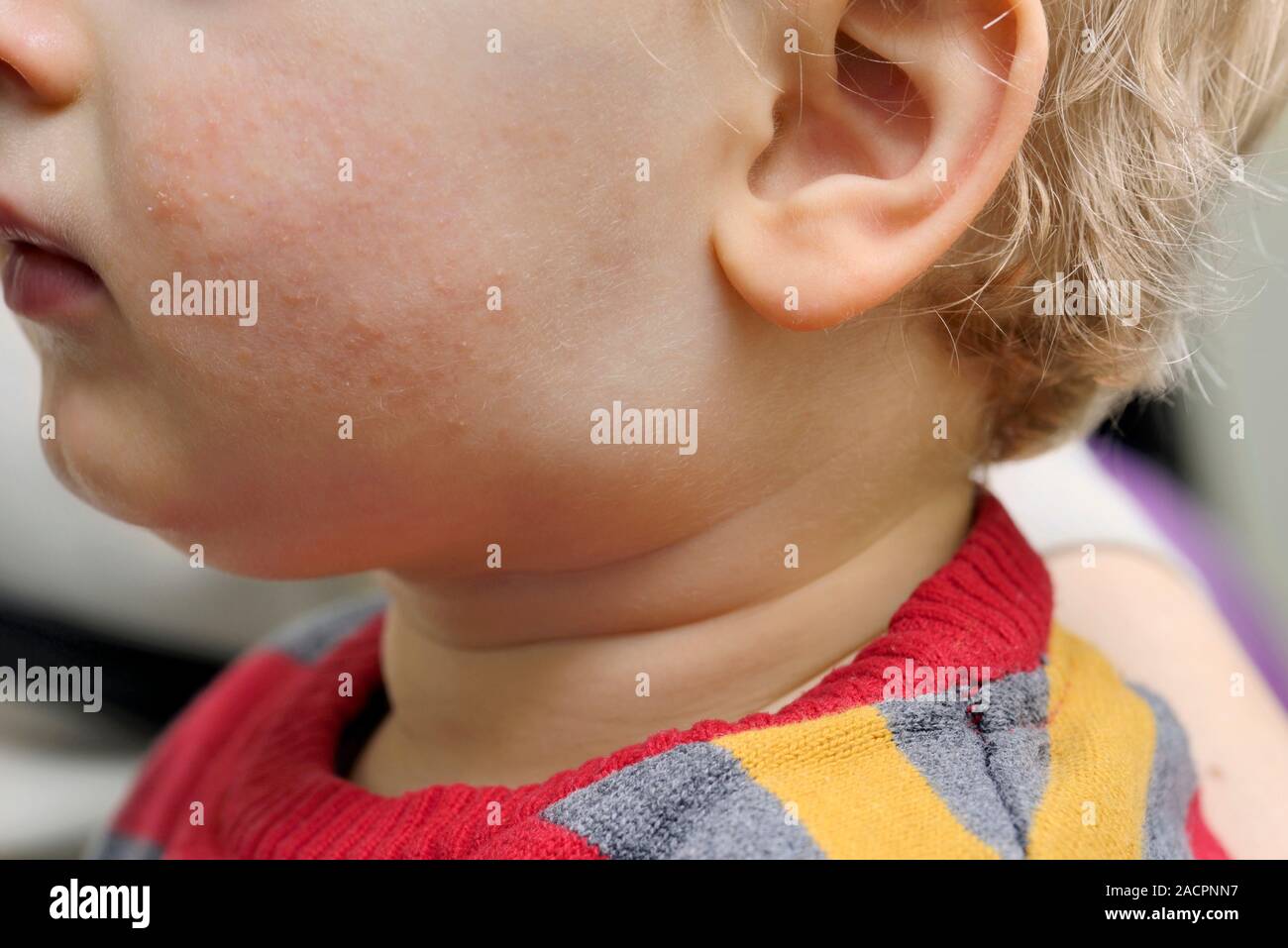 Not for use in Television Not for use in Television Mumps. Swollen ...