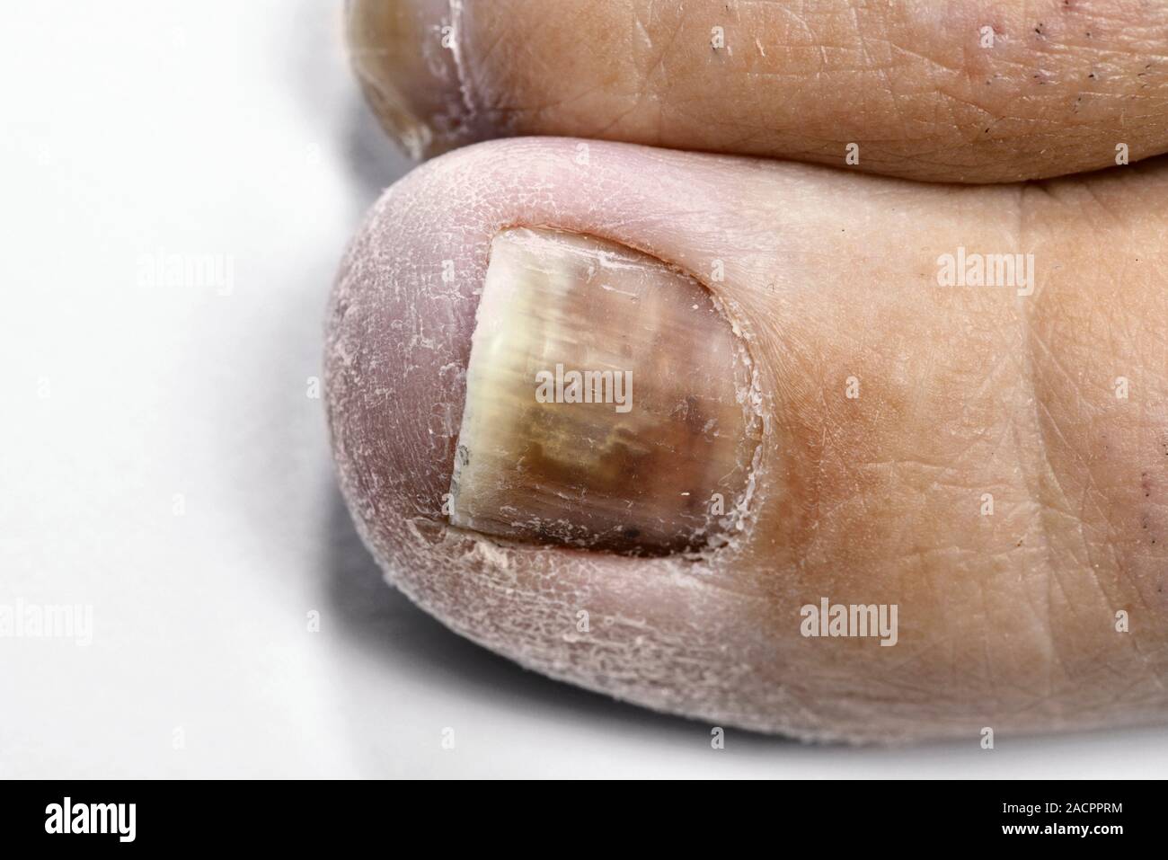 Not for use in Television Not for use in Television Fungal nail ...