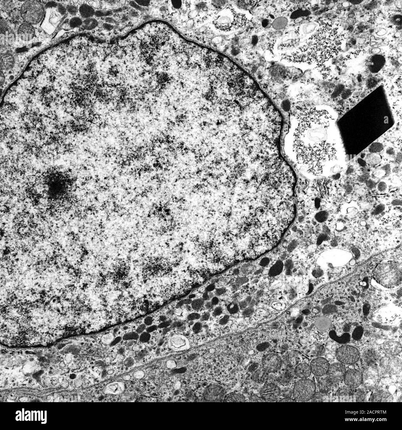 Alveolar soft part sarcoma. Transmission electron micrograph (TEM) of a ...