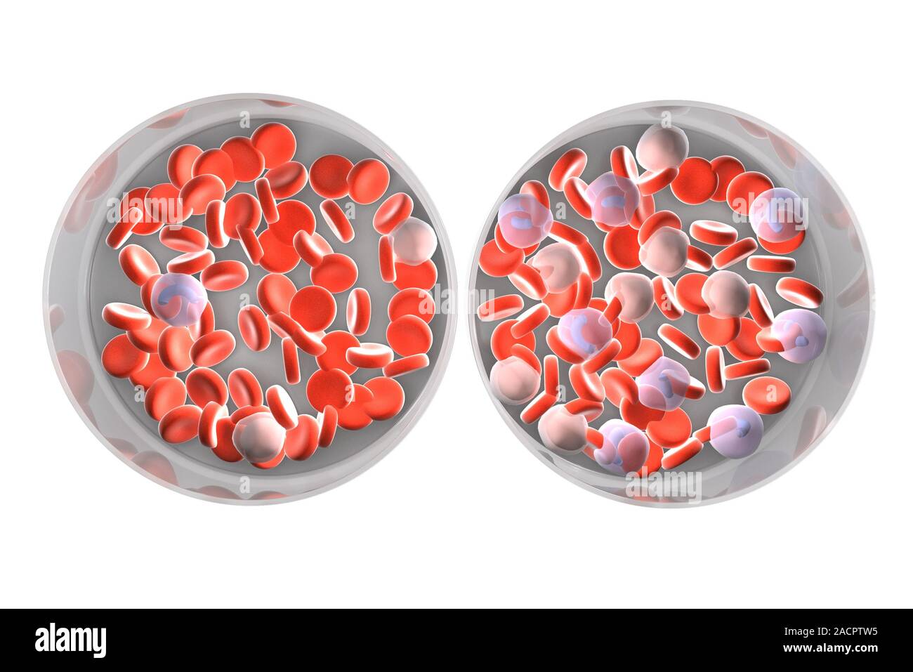 Normal and leukaemic blood. Computer artwork comparing the appearance ...