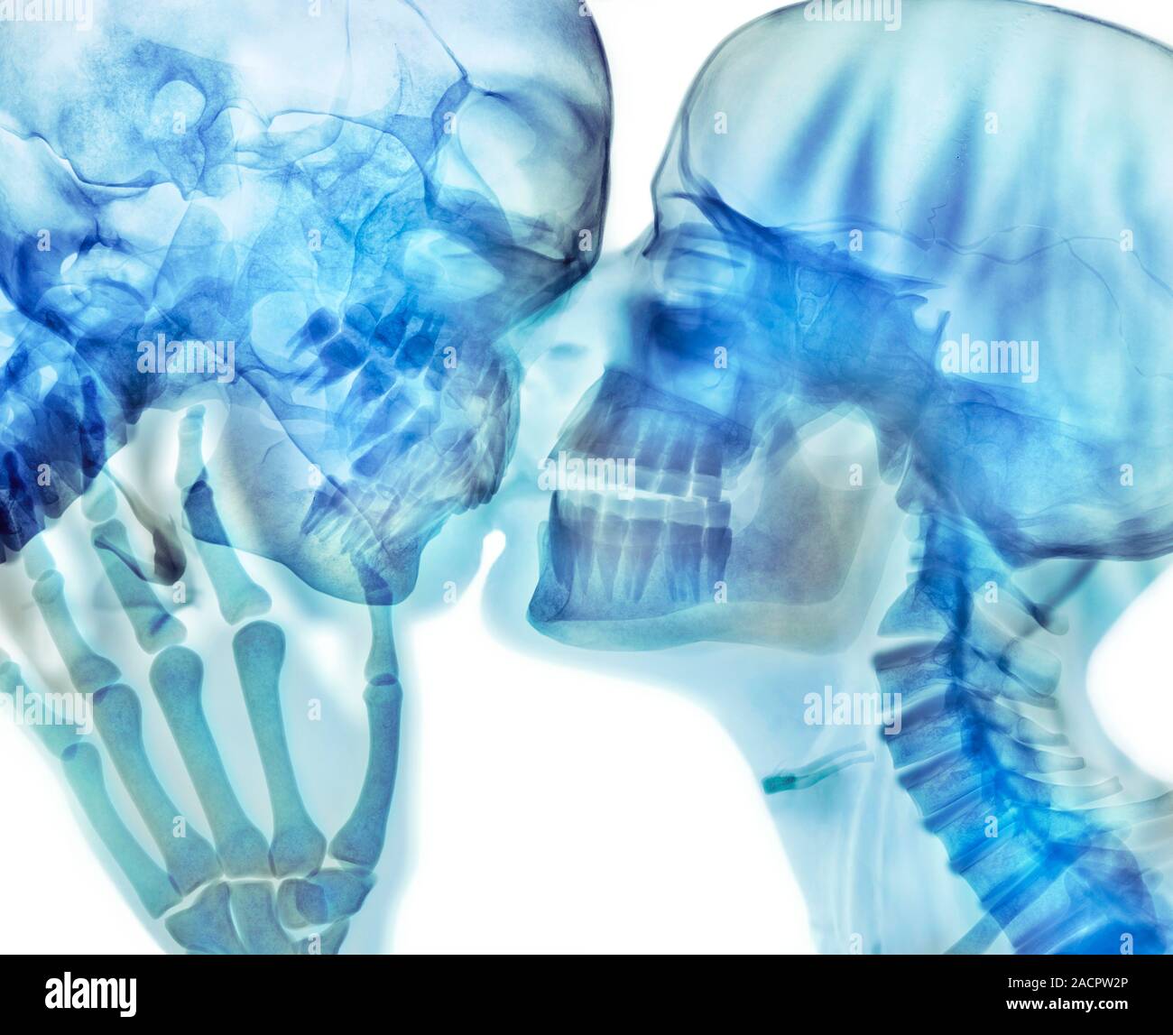Lovers kissing, coloured X-ray Stock Photo - Alamy