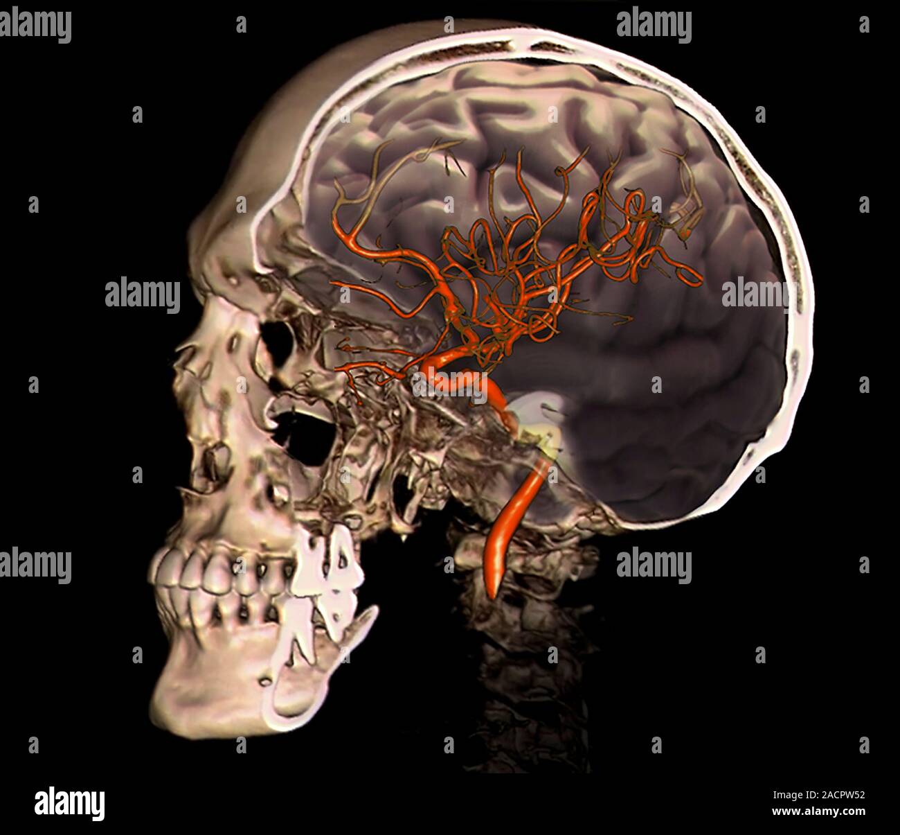 External carotid artery. Coloured 3D computed tomography (CT) angiogram (blood vessel scan) of ...
