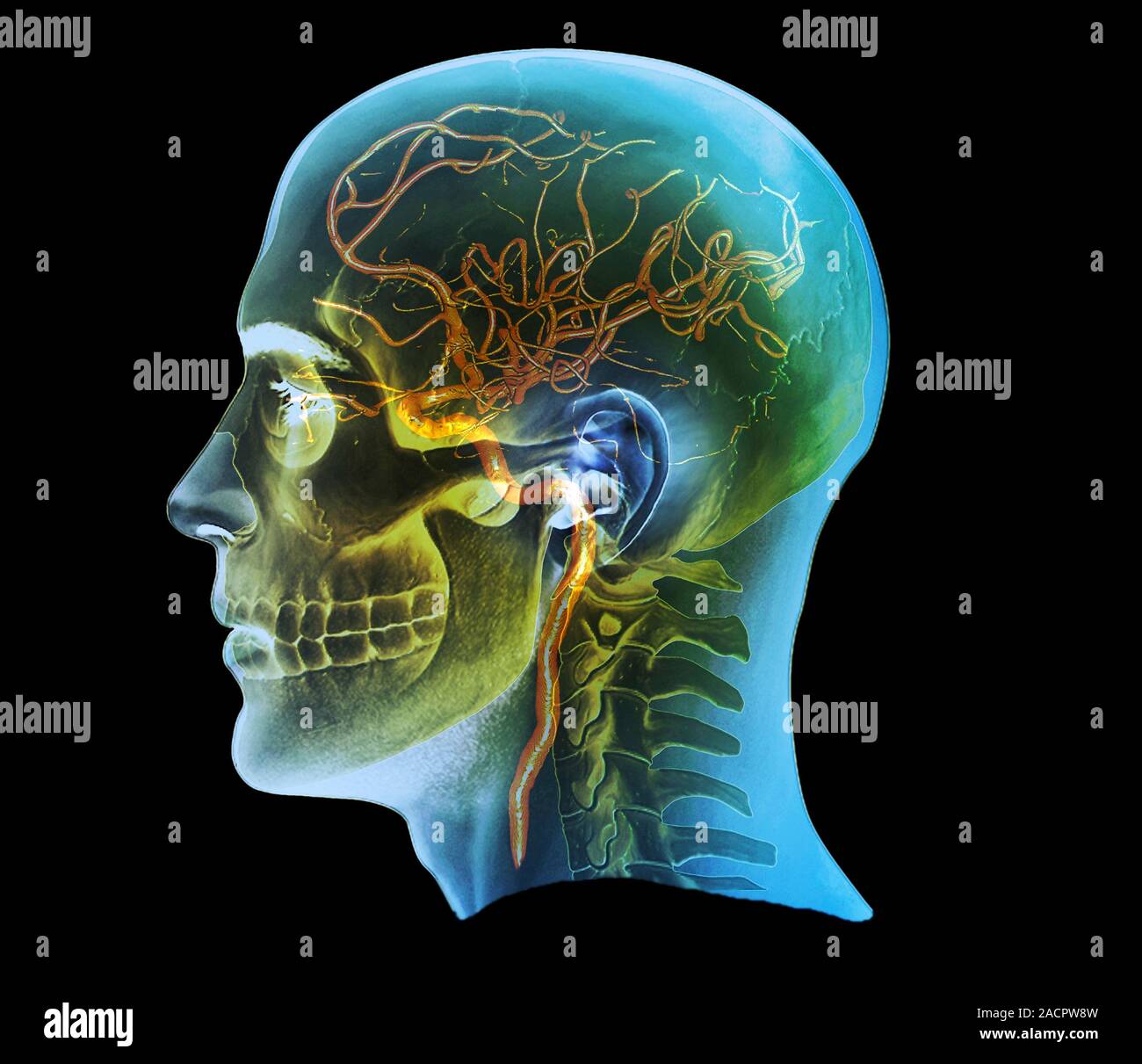 Internal carotid artery. Coloured 3D computed tomography (CT) angiogram (blood vessel scan) of ...