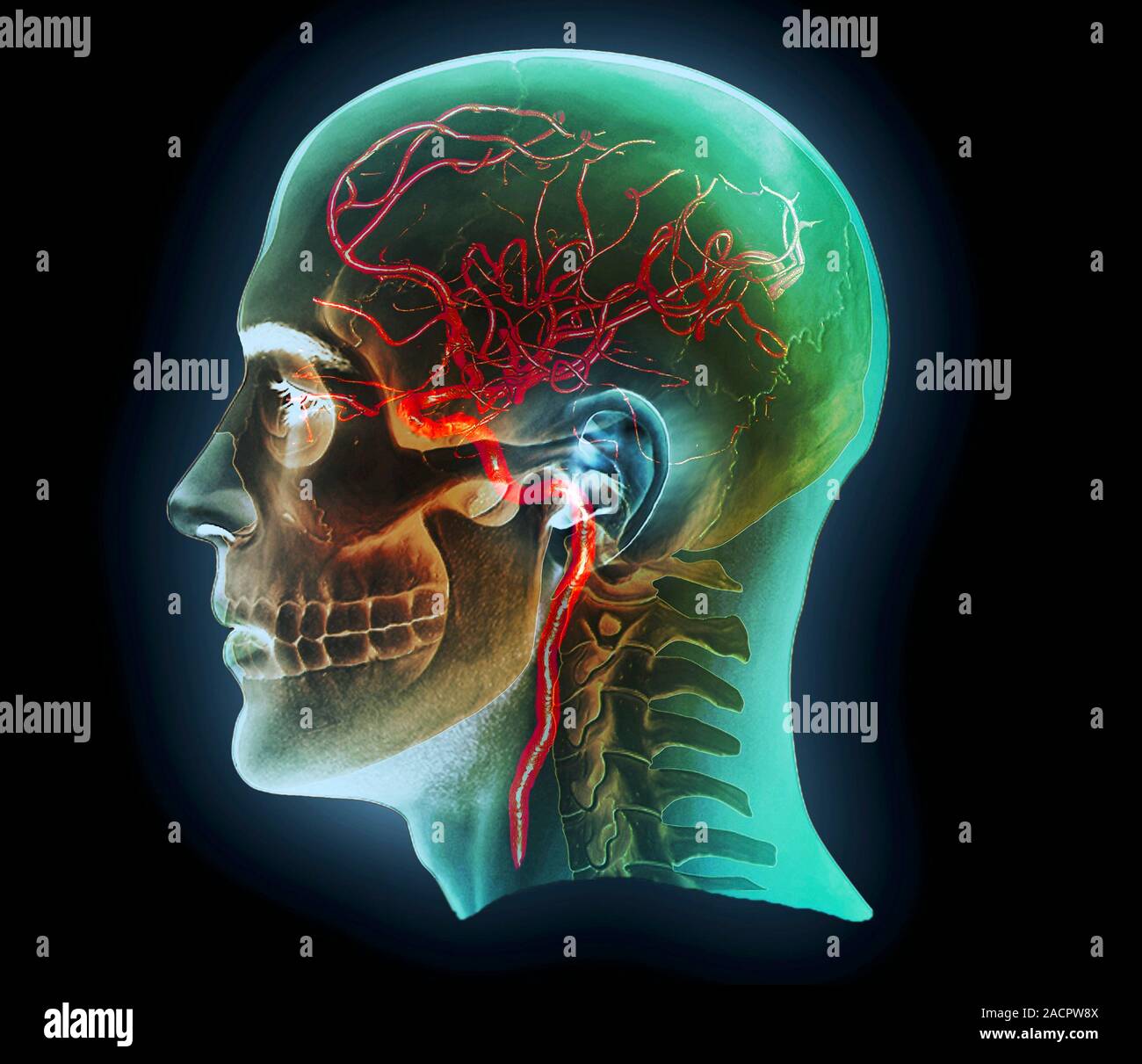 Internal carotid artery. Coloured 3D computed tomography (CT) angiogram (blood vessel scan) of ...