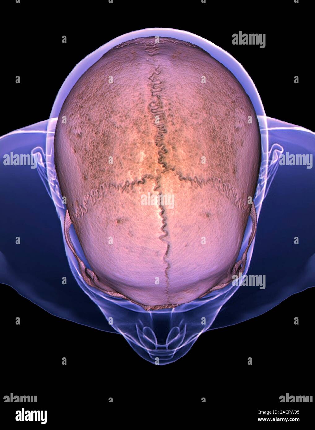 Skull sutures. 3D computed tomography (CT) scan of the surface of a ...
