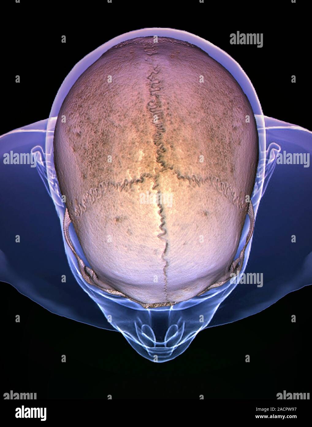 Skull sutures. 3D computed tomography (CT) scan of the surface of a ...