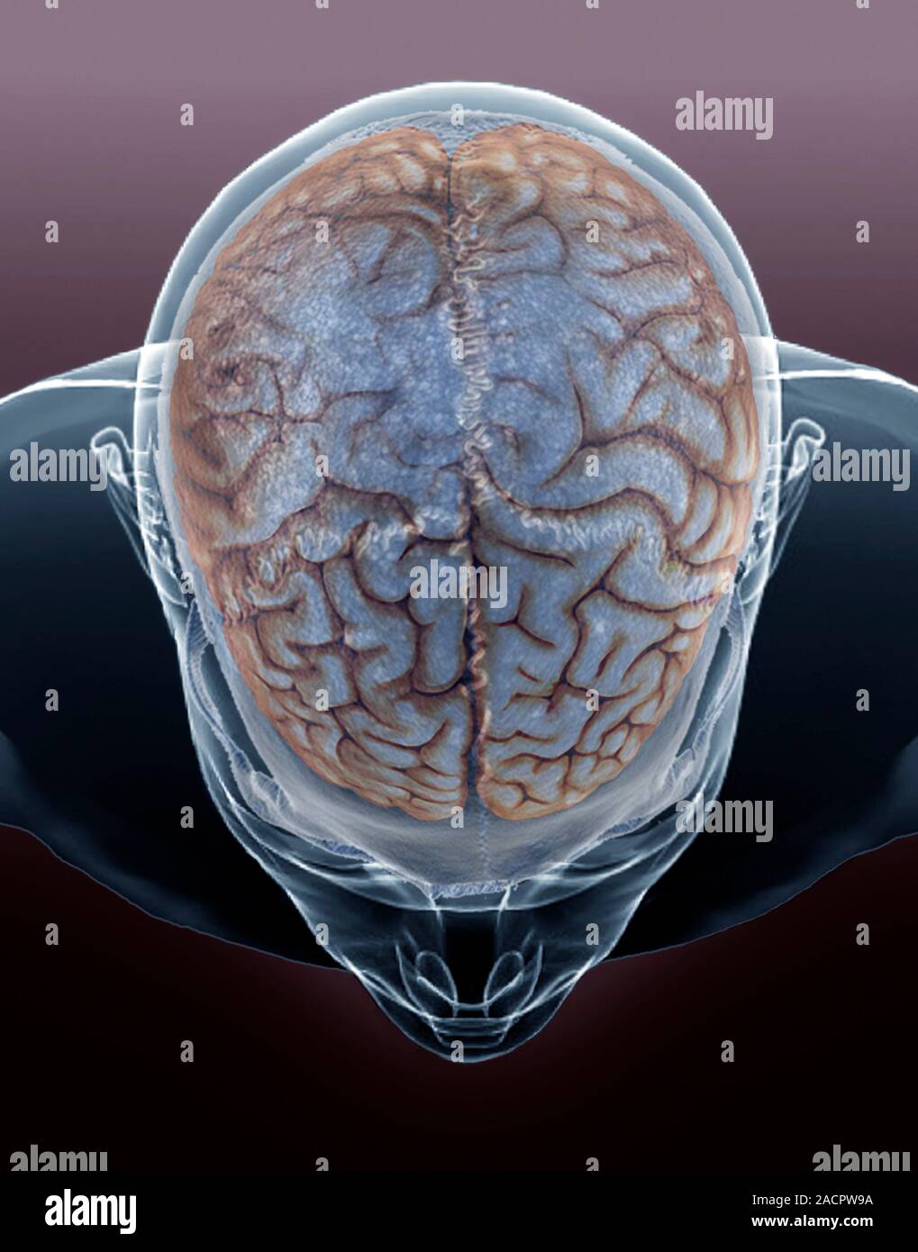 Human head. Coloured composite image of a magnetic resonance imaging (MRI) scan of the brain and ...