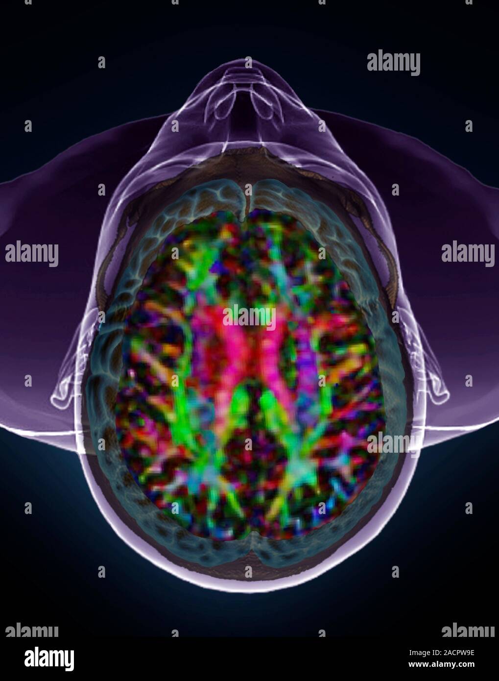 Human head. Coloured composite image of a diffusion tensor imaging (DTI) scan of the brain and a ...
