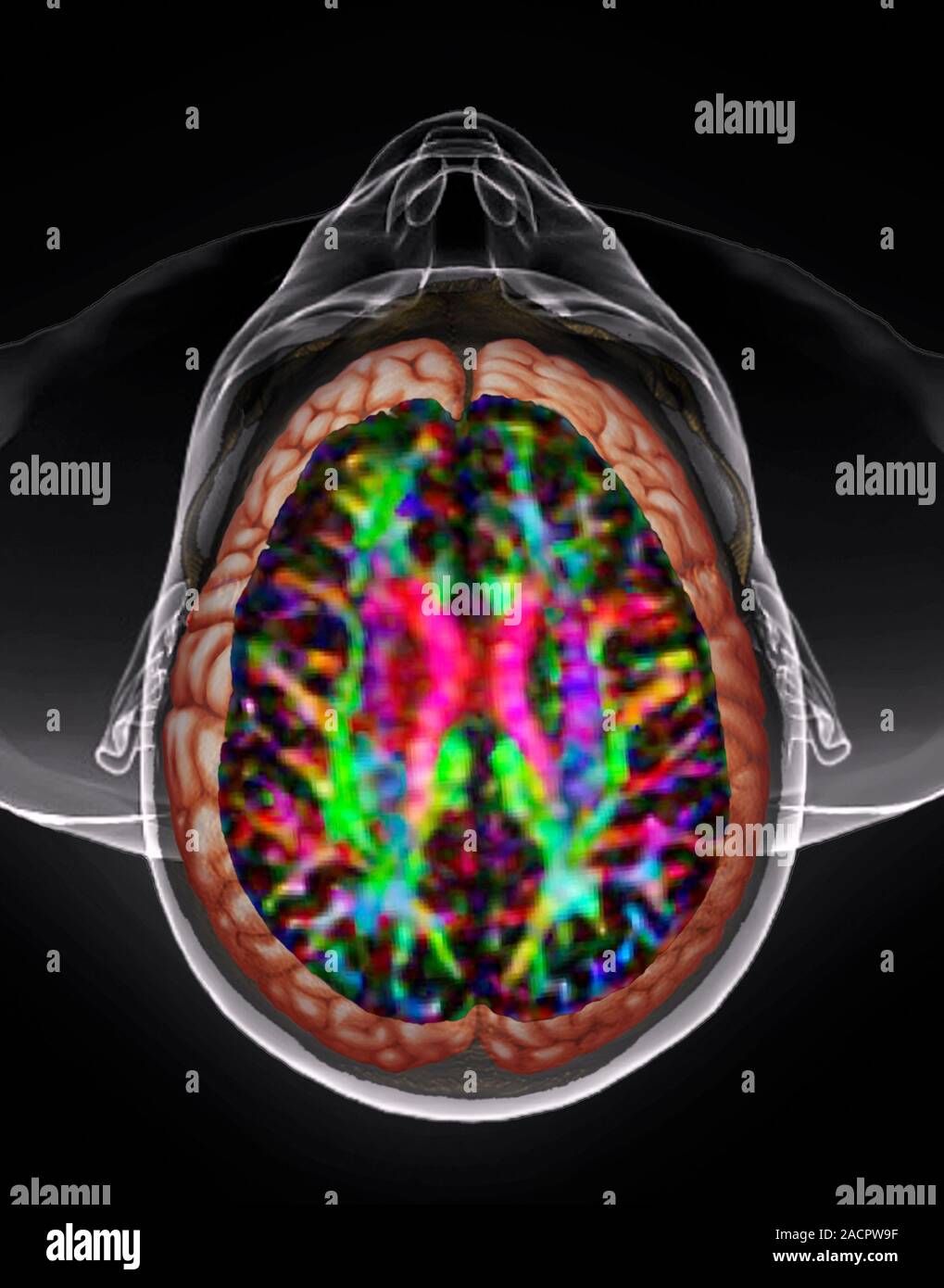 Human head. Coloured composite image of a diffusion tensor imaging (DTI ...