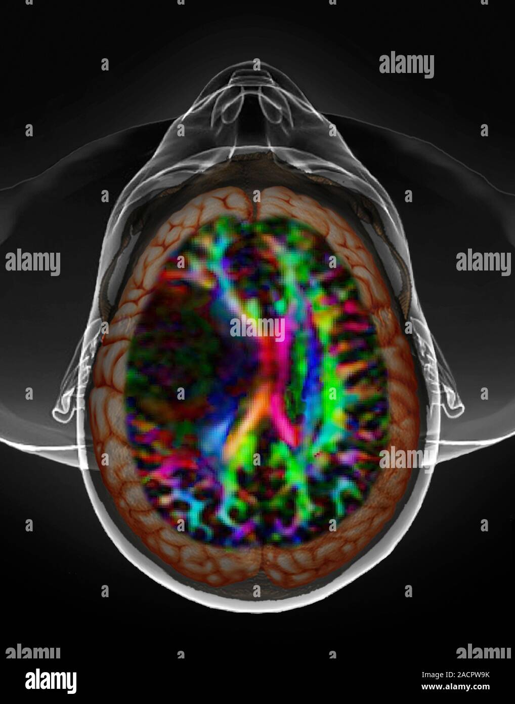 Brain cancer. Coloured composite image of a diffusion tensor imaging (DTI) scan of the brain and ...
