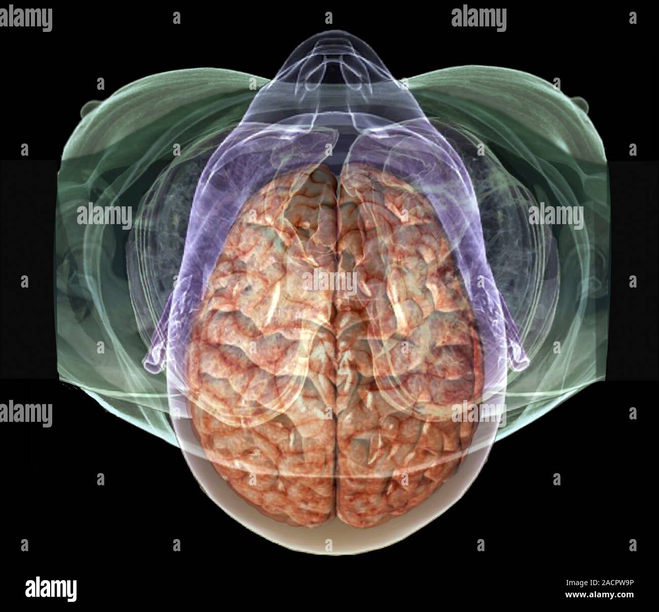 Human head. Coloured composite image of a magnetic resonance imaging ...