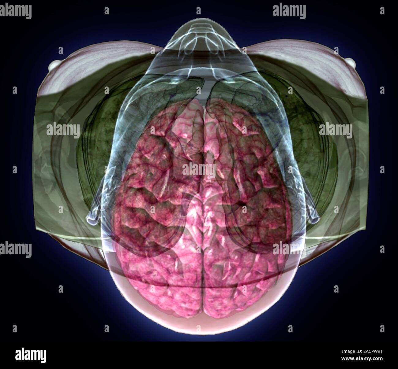 Human head. Coloured composite image of a magnetic resonance imaging (MRI) scan of the brain and ...