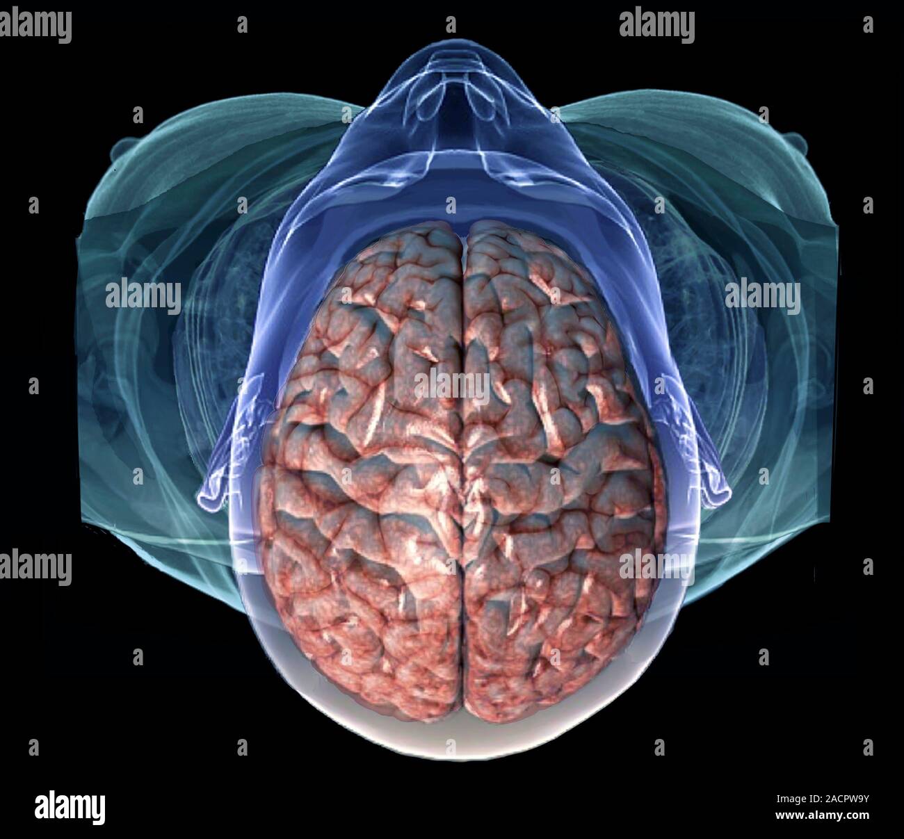 Human head. Coloured composite image of a magnetic resonance imaging (MRI) scan of the brain and ...