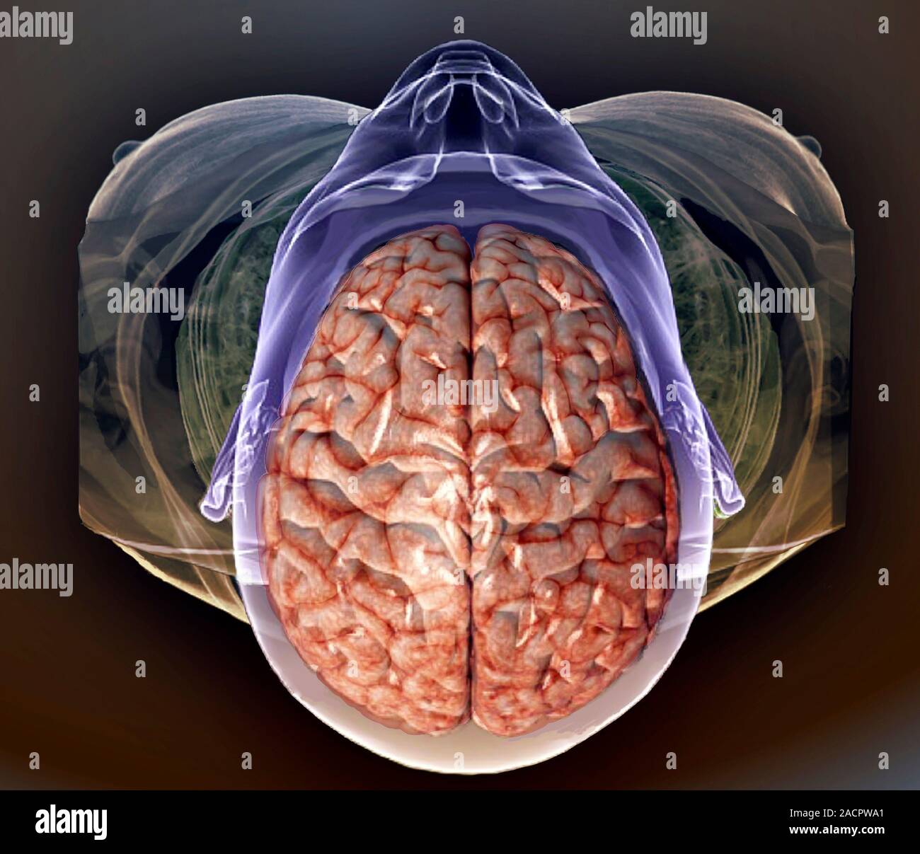 Human head. Coloured composite image of a magnetic resonance imaging (MRI) scan of the brain and ...