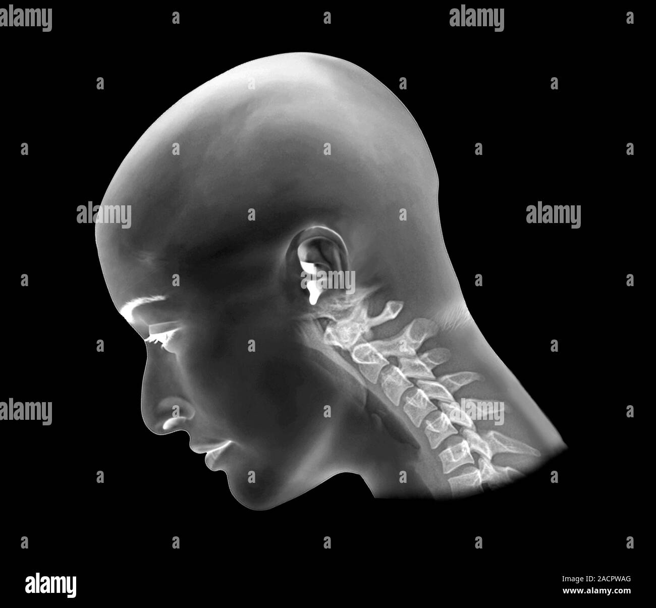 Normal flexed neck. X-ray of a 35 year old patient's healthy flexed ...