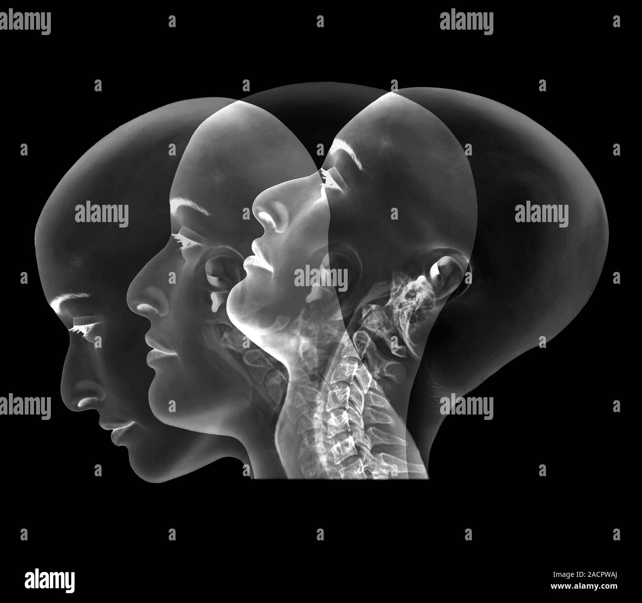 Normal neck. Three X-rays of a 35 year old patient's healthy cervical ...