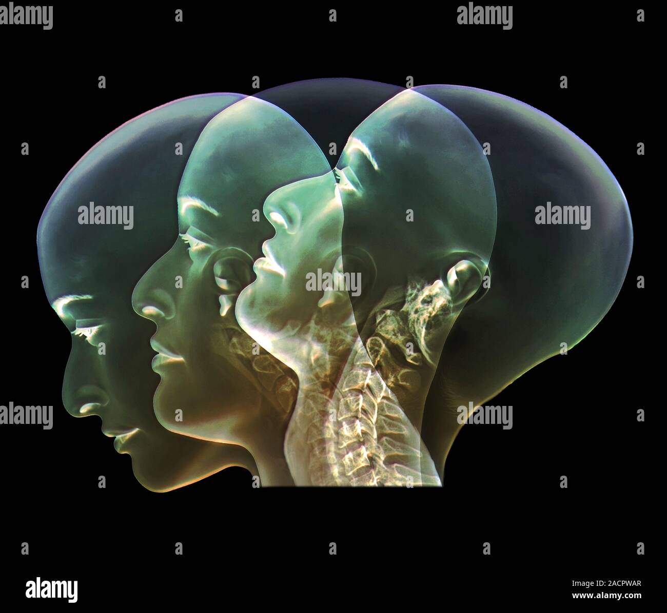 Normal neck. Three coloured X-rays of a 35 year old patient's healthy ...