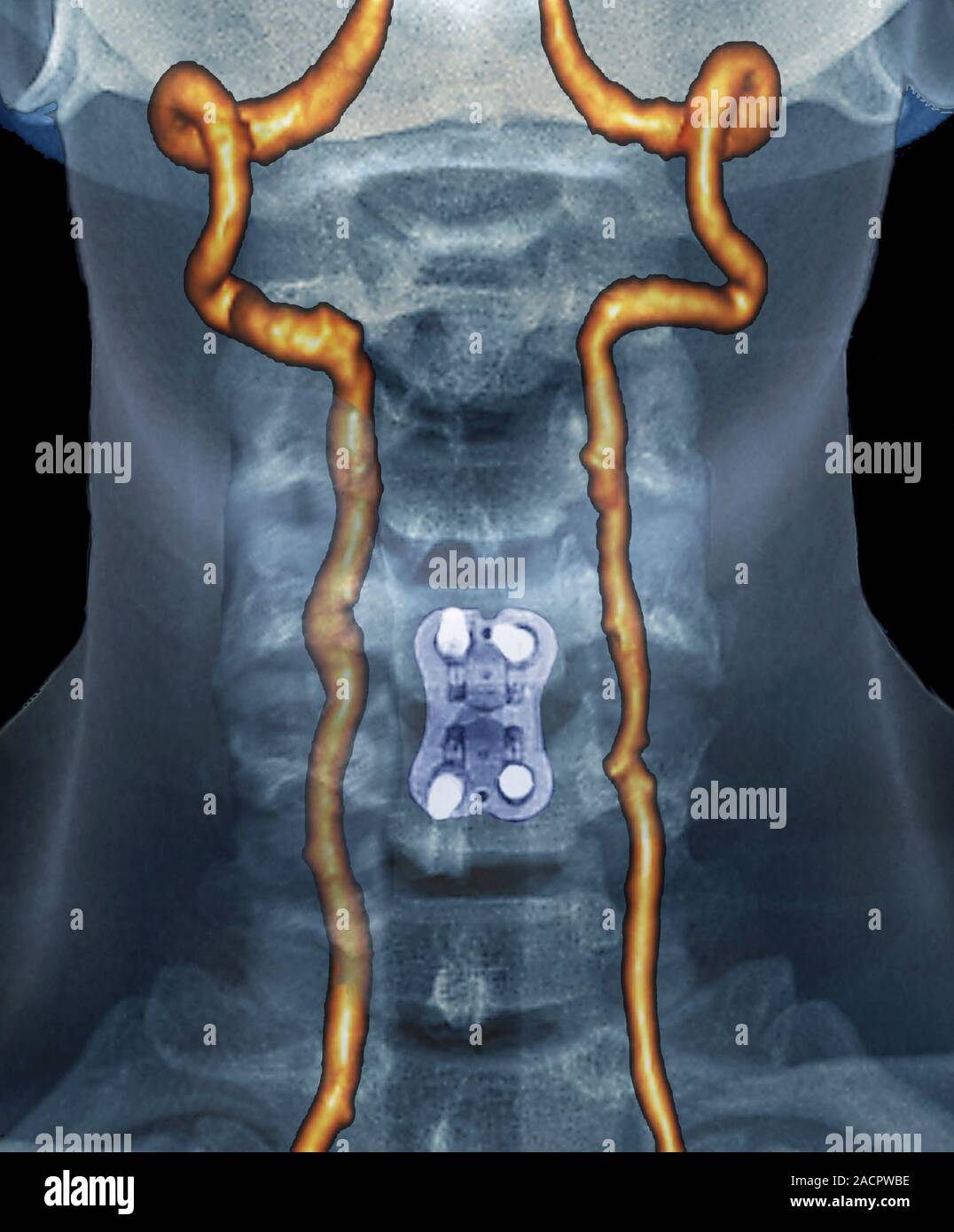 Neck arthritis treatment. Coloured X-ray angiogram of the neck of a 48 ...