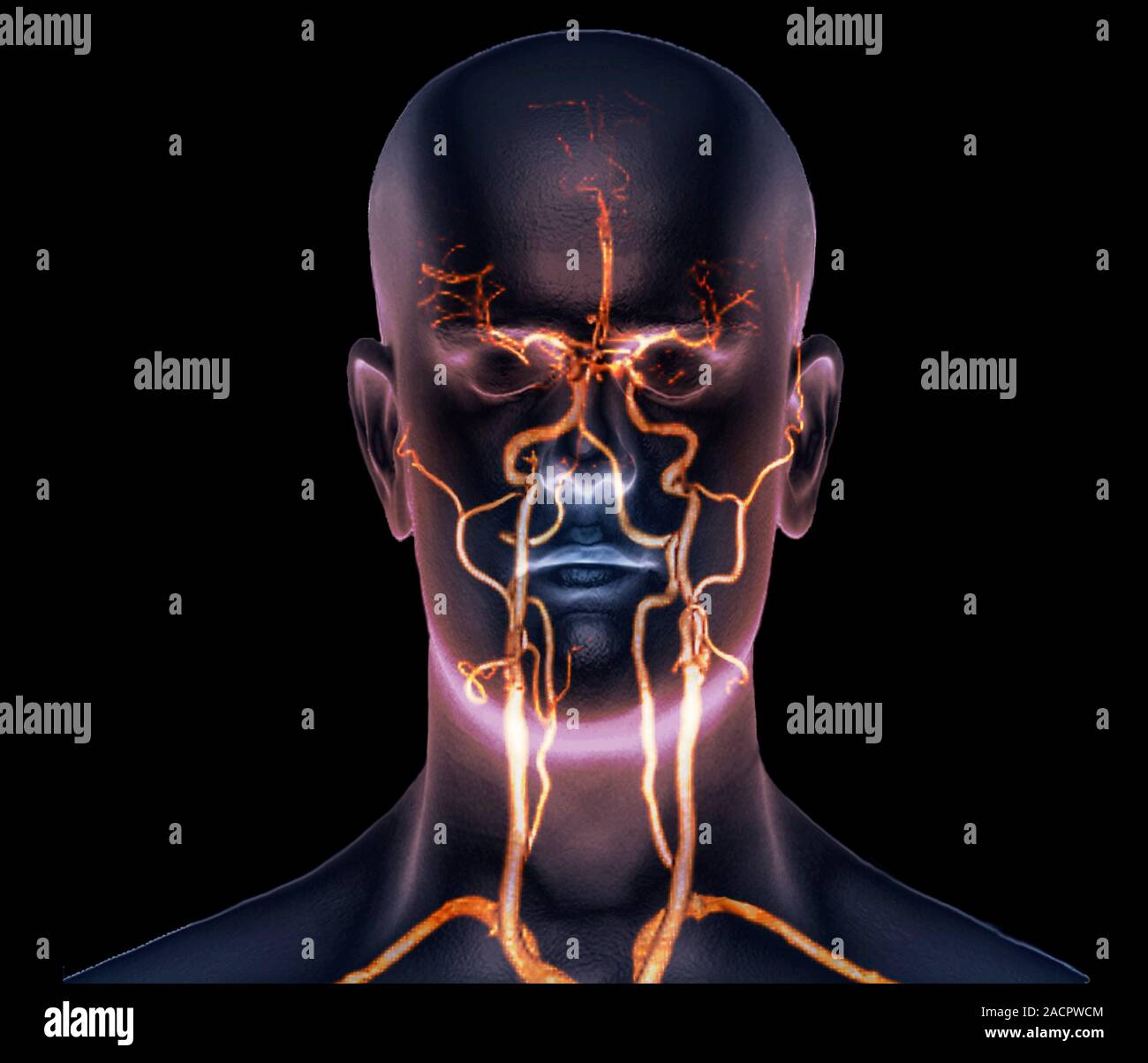 Neck and head arteries. Coloured magnetic resonance angiography (MRA ...
