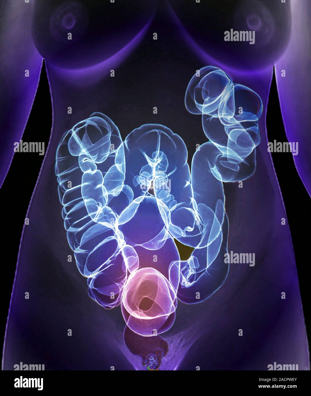 Healthy large intestine. Coloured 3D computed tomography (CT) scan of ...
