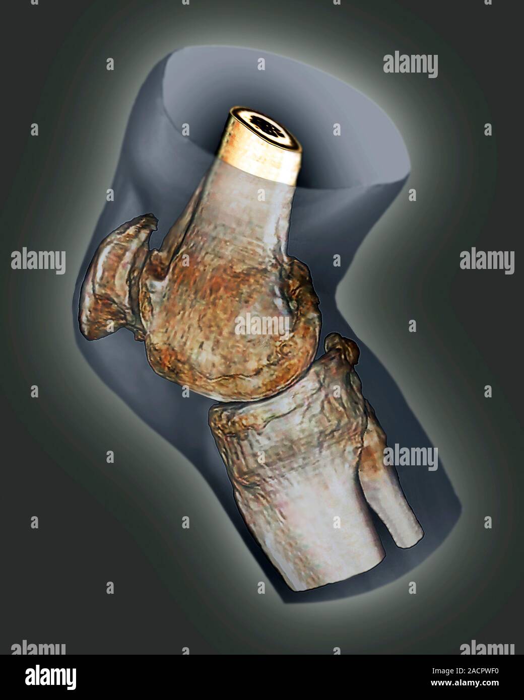 Arthritis of the knee. Coloured 3D computed tomography (CT) scan of the ...