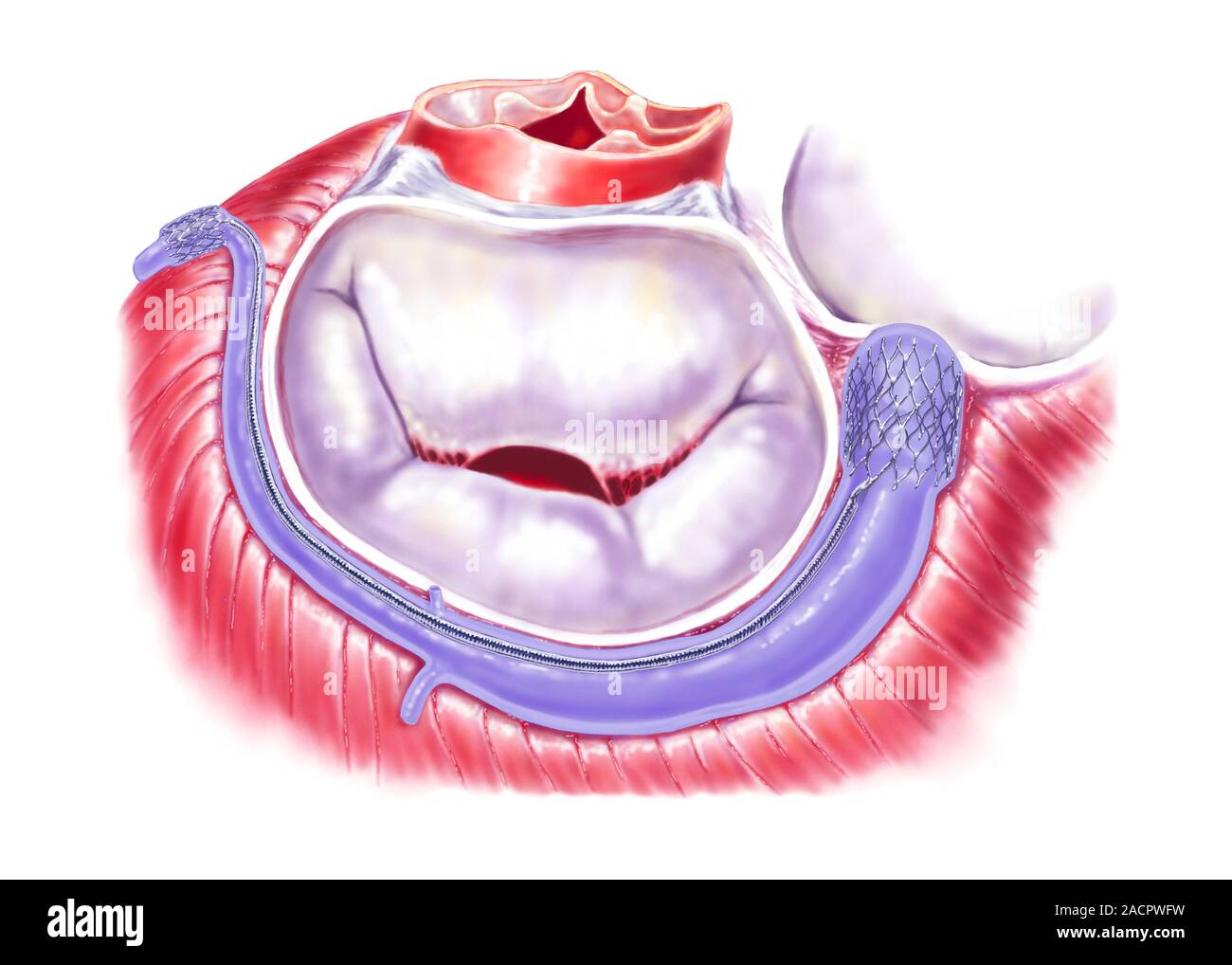 Mitral valve annuloplasty. Artwork of the heart's mitral valve and the ...
