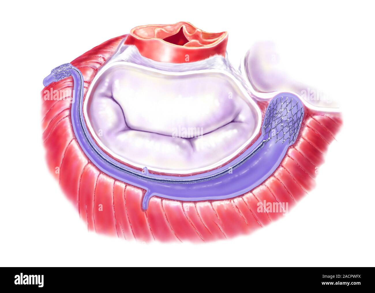 Mitral valve annuloplasty. Artwork of the heart's mitral valve and the ...
