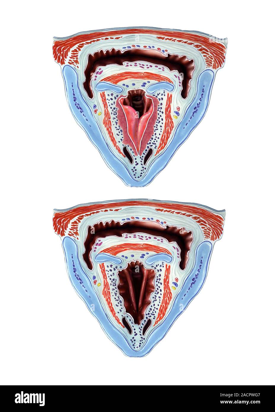 Oedema of larynx. Artwork of a transverse (axial) section through a ...