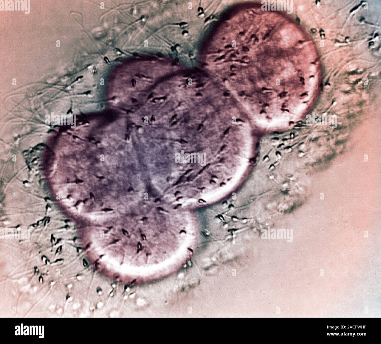 IVF treatment. Light microscope of human egg cells (large, round) and ...