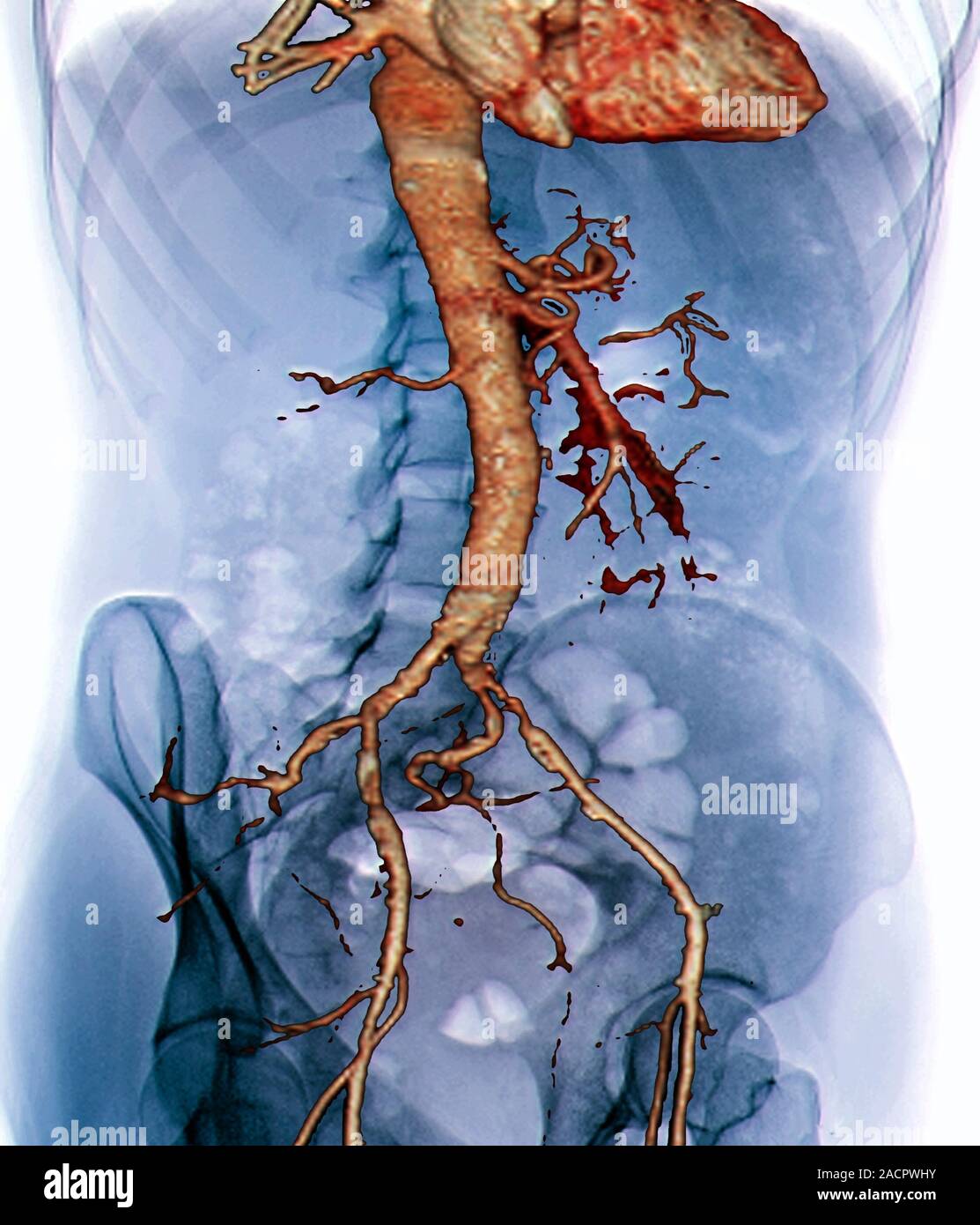 Abdominal aorta. Coloured 3D computed tomography (CT) scan of the ...