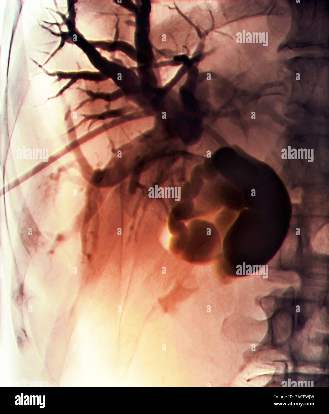 Biliary drainage. Coloured X-ray of the abdomen of an 69 year old ...
