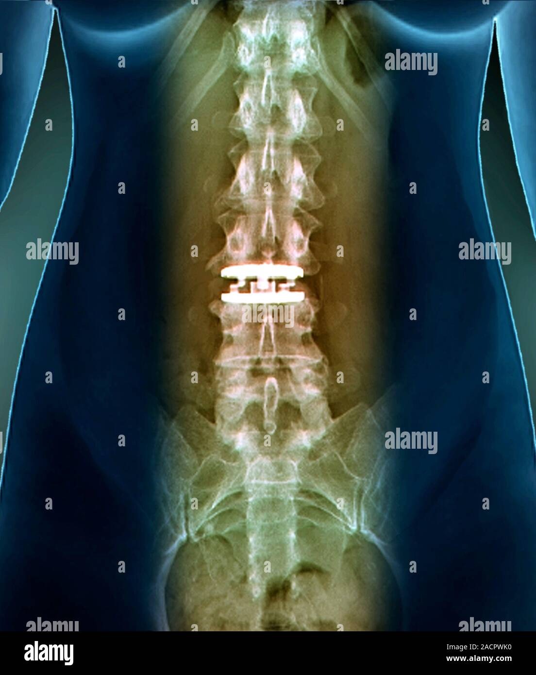 Artificial spinal disc. Coloured X-ray of the spine of a 42 year old ...
