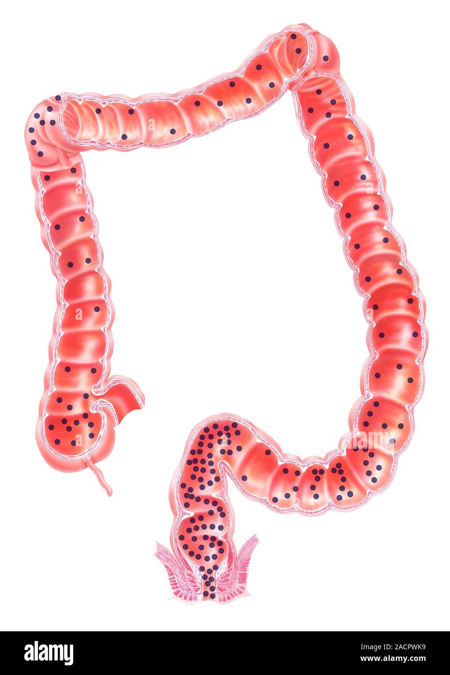 Colon cancer locations. Cutaway artwork of the large intestine and ...