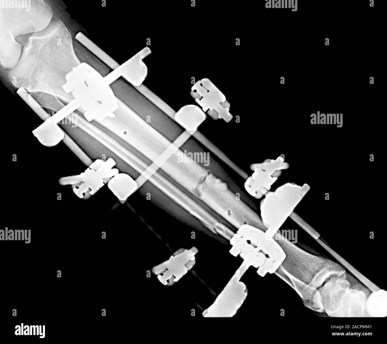 Pinned leg fracture. X-ray of the leg of a 33 year old patient that has ...